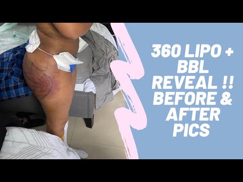 Part 3 l Reveal !! l 360 Lipo + BBL Journey l Mia Aesthetics l Dr ...