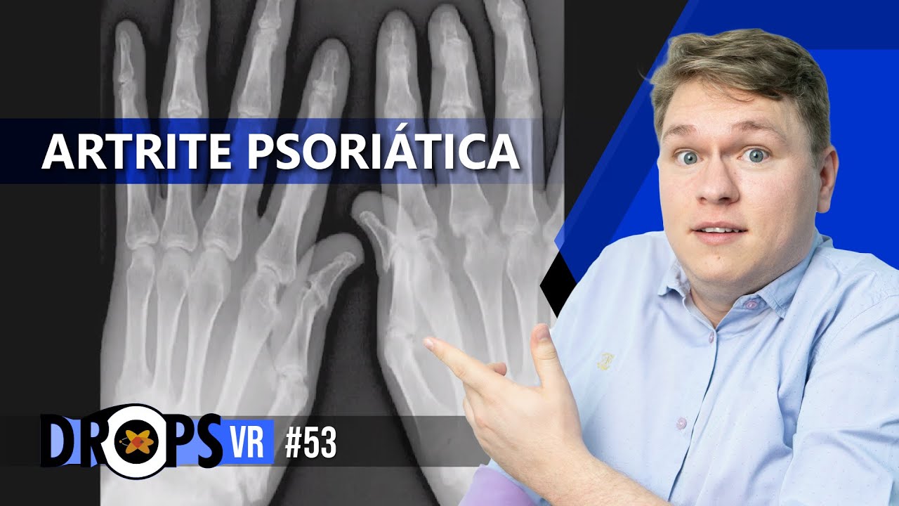 APRENDA A IDENTIFICAR ARTRITE PSORIÁTICA NO RAIO X - YouTube