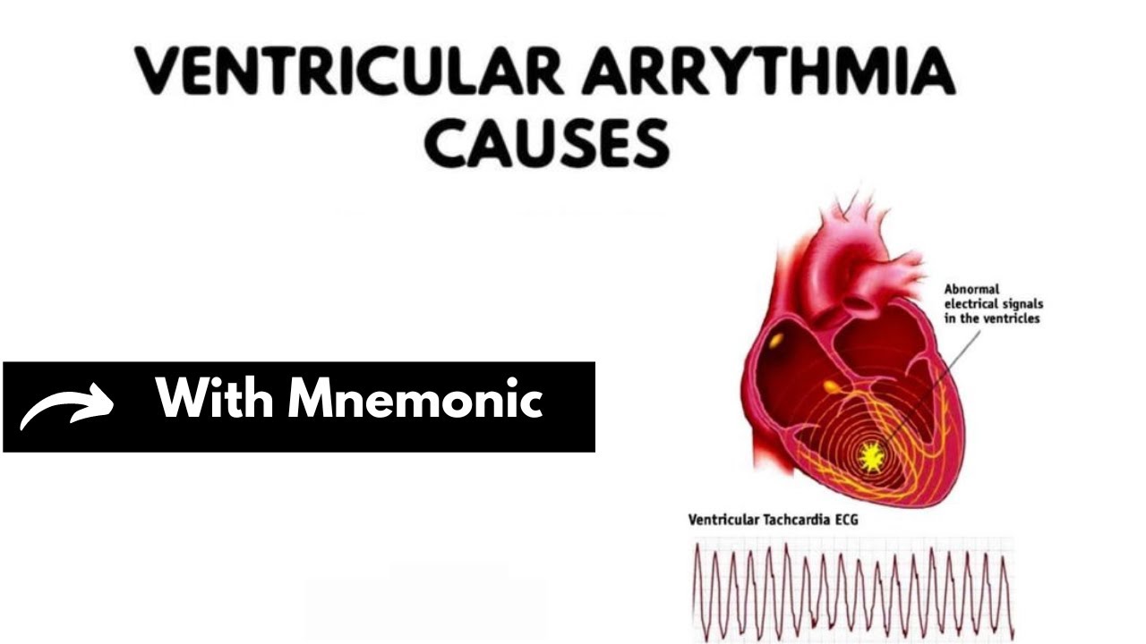 Ventricular Arrhythmia Causes With Mnemonic | Medicine Mnemonics | Dr ...