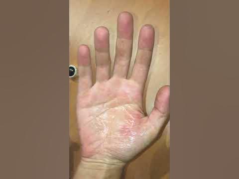 Что делать при ожоге руки или пальца! Как снять боль и жжение? - YouTube