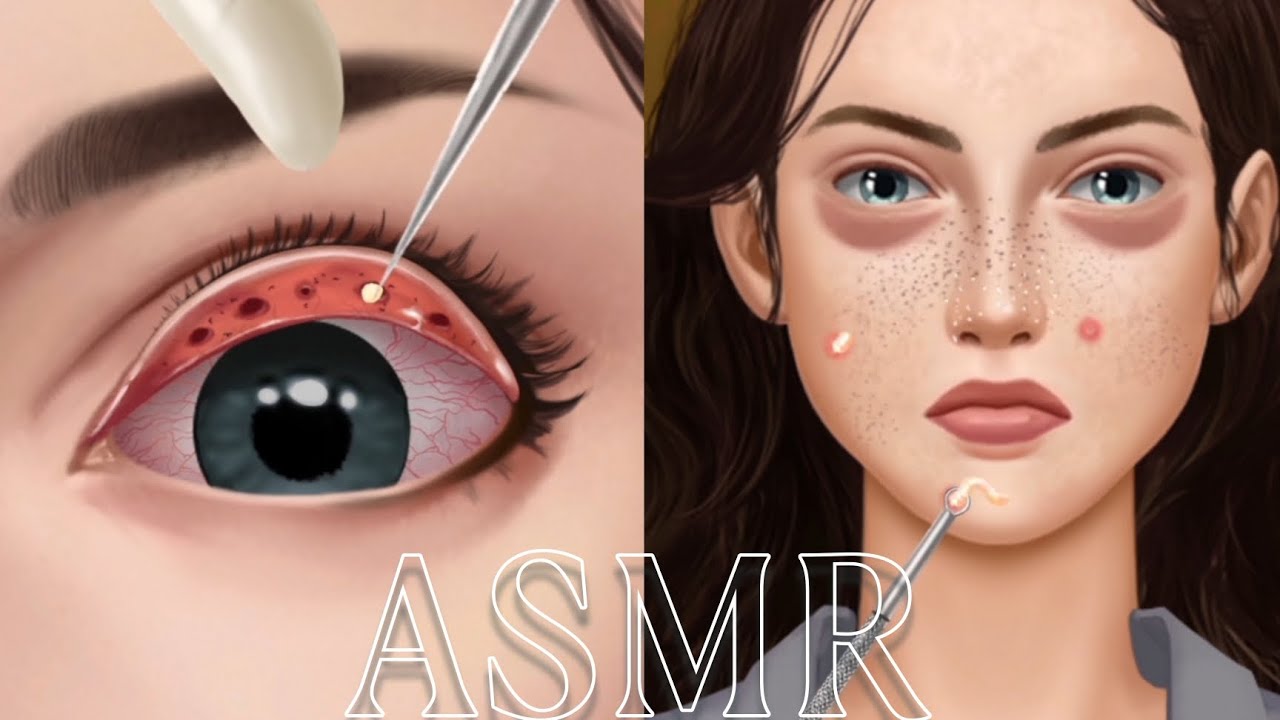 ASMR Body Treatments! Acne Removal Satisfying Video | Mouth Cleaning ...