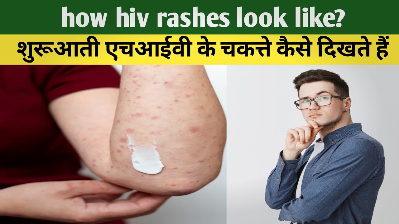 how early hiv rashes look like?एचआईवी के शुरूआती चकत्ते कैसे दिखते हैं ...