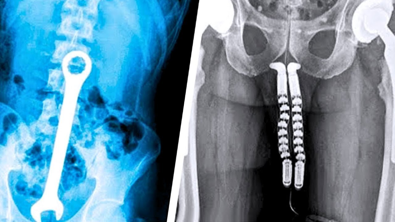 20 Weirdest Things Discovered by X-Rays! - YouTube