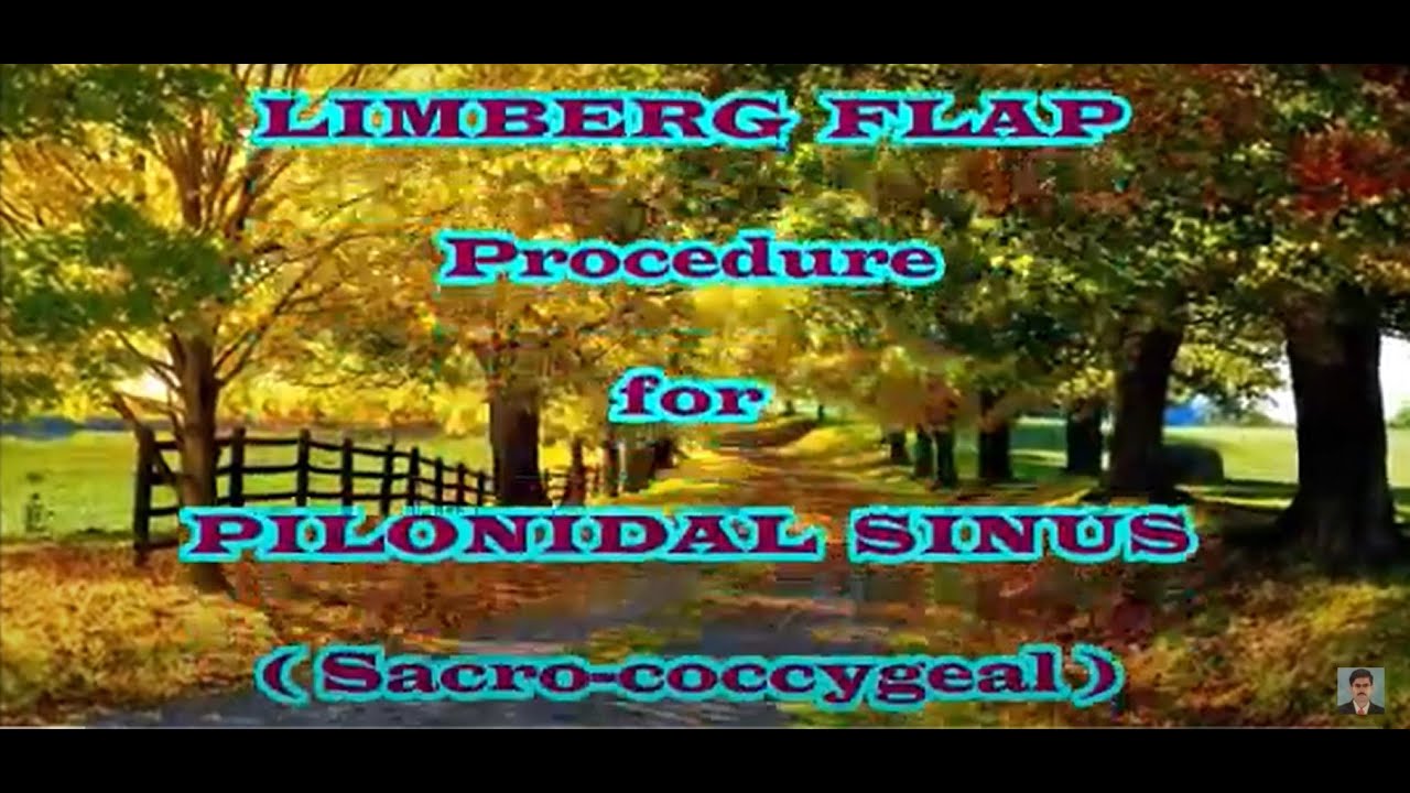 LIMBERG FLAP for PILONIDAL SINUS - SKP Surgery Videos - YouTube