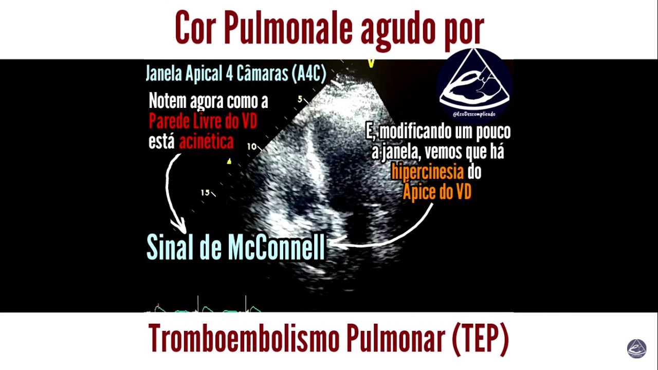 [Casos de ECO] TEP - Embolia Pulmonar com Cor Pulmonale agudo e Sinal ...