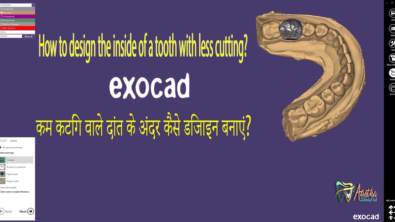 Copy of exocad bridge design || exocad crown design || exocad bar ...