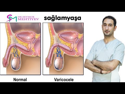 Varikosel nədir? | Sağlam Yaşa