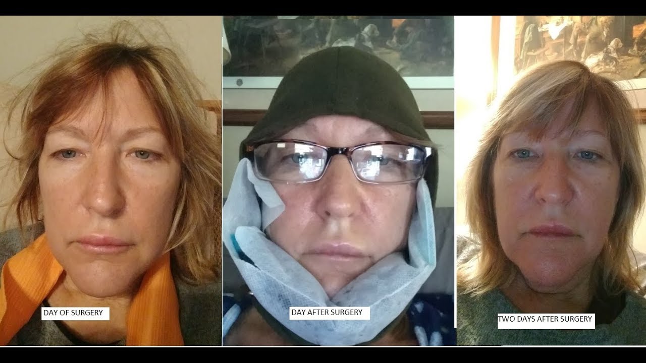 Brown Farm Mandibular Tori Removal Post-op - YouTube