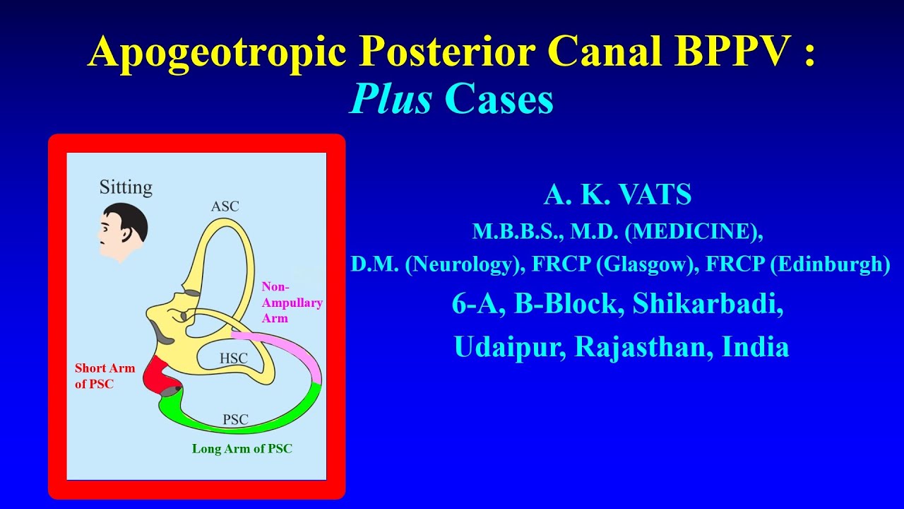 Apogeotropic Posterior Canal BPPV - Newer Insights - YouTube