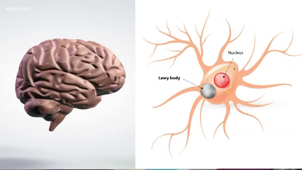 Contact Sports Linked To Lewy Body Dementia YouTube contact-sports-linked-to-lewy-body-dementia-youtube