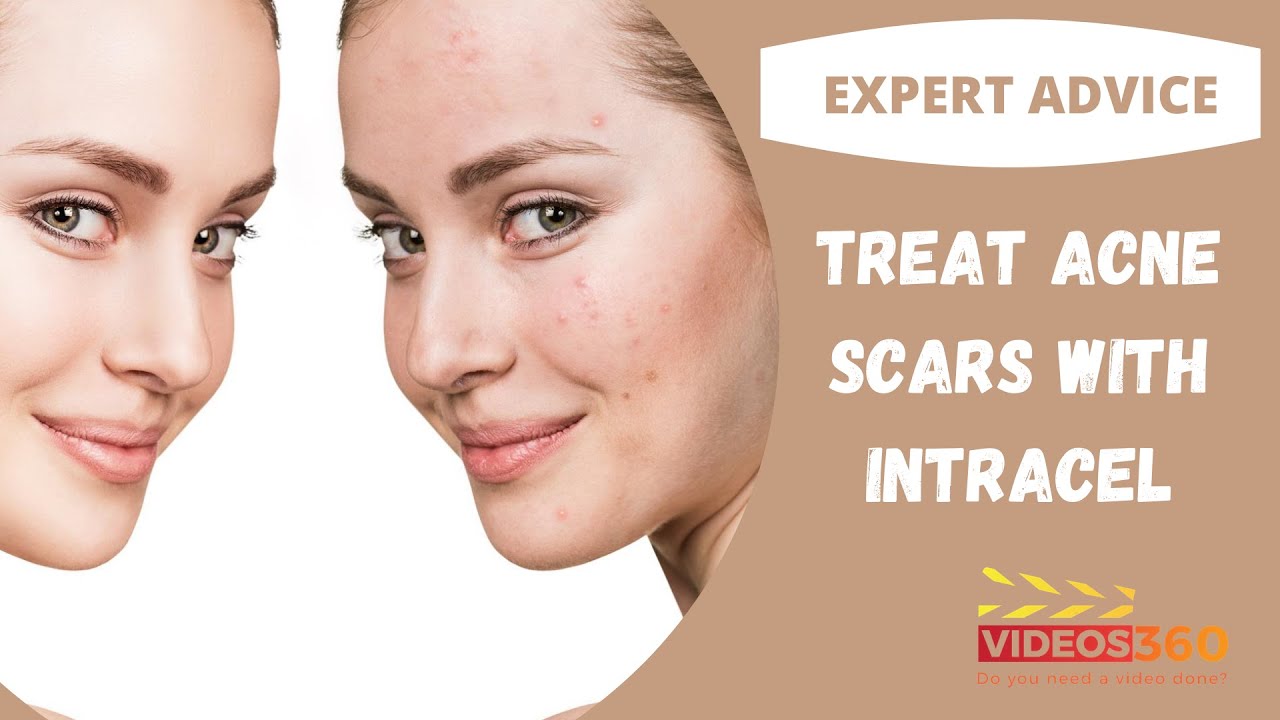 INTRacel Acne Scar treatment explained by Dr Jeanine Downie - YouTube