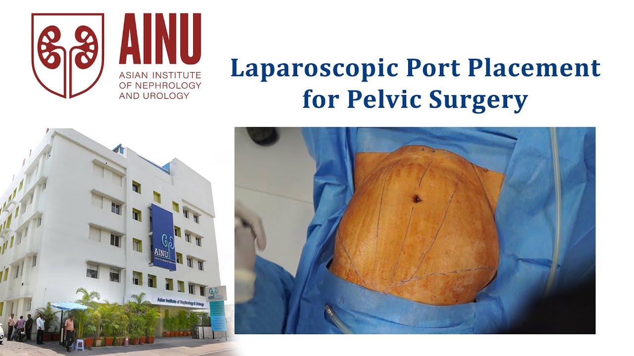 Laparoscopic Port Placement for Pelvic Surgery | AINU Surgical Videos ...