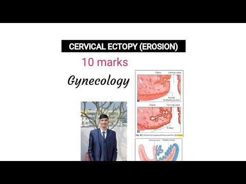 CERVICAL ECTOPY (EROSION) Gynecology 10 marks mpmsu bhms mbbs bams ...