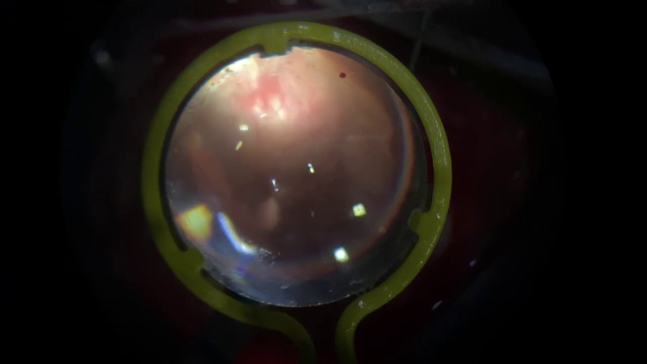 Repair of RD from Giant Retina Tear - YouTube