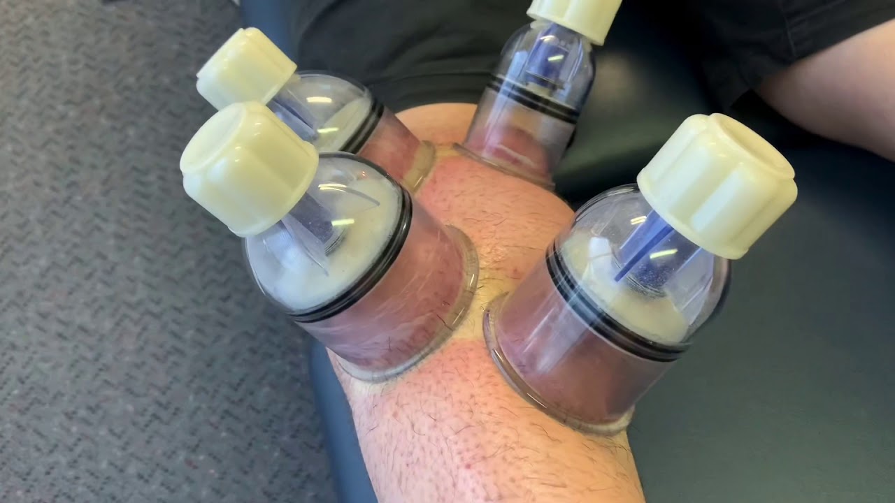 Cupping of the Calf - YouTube