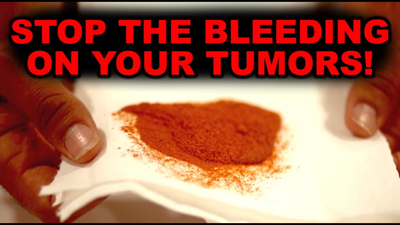How To Stop Your Tumor From Bleeding!!!! - YouTube