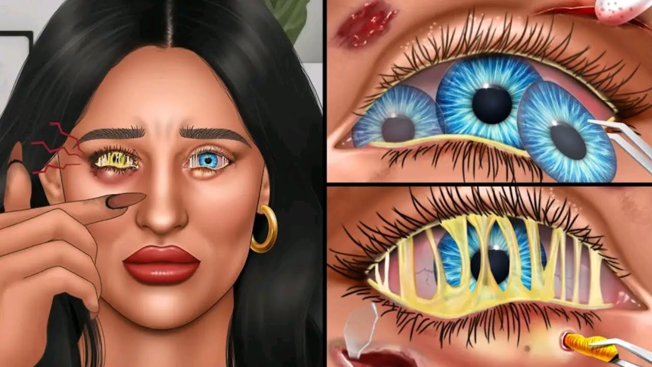 ASMR remove 6 layers of content Lenses eye infections /clean eye - YouTube
