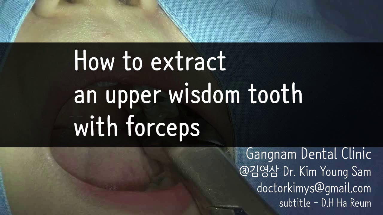 How to extract an upper wisdom tooth with forceps - YouTube