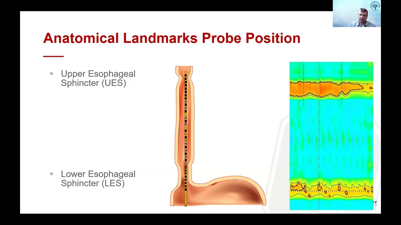 Upper Esophageal Sphincter Manometry