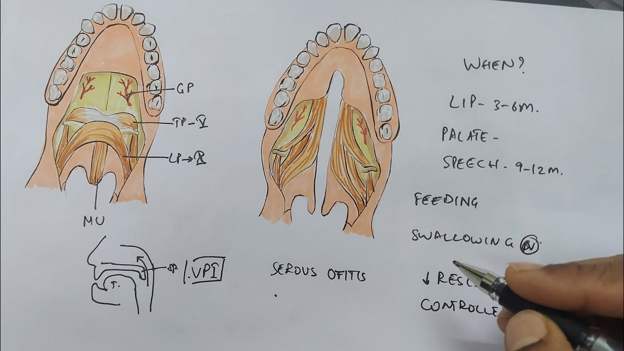 EMBRYOLOGY AND PATHO ANATOMY OF CLEFT LIP AND PALATE - FOR CLEFT ...
