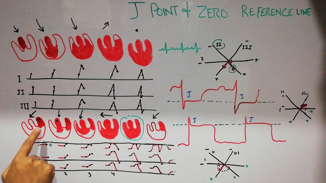 CVS physiology 40. J point and zero reference line in current of injury ...