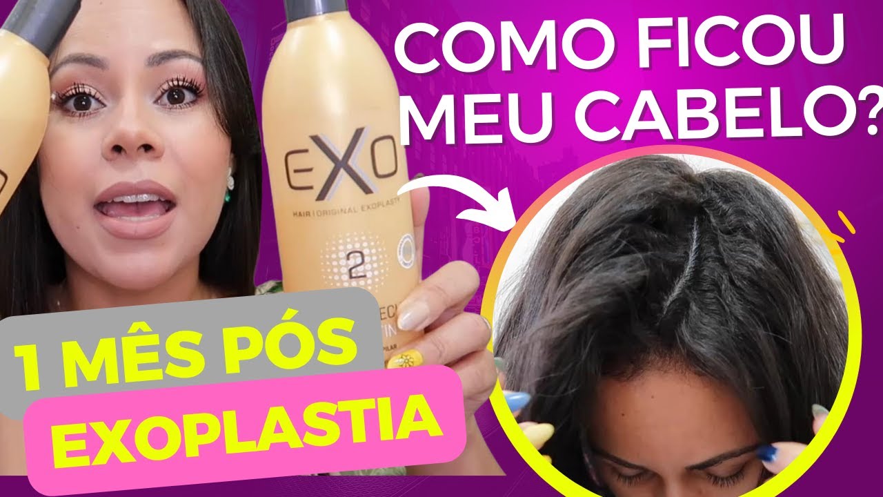 1 MÊS PÓS EXOPLASTIA 🙄OLHA COMO FICOU MEU CABELO - YouTube