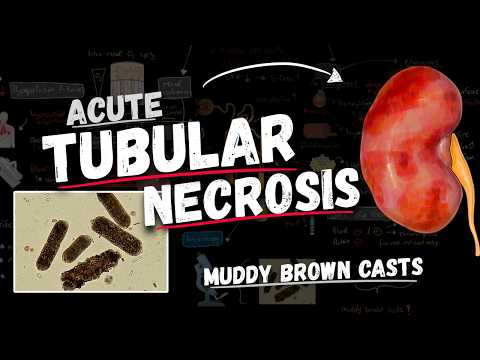 Acute Tubular Injury (Necrosis) explained!