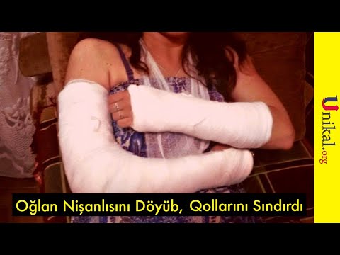 Oğlan Nişanlısını Döyüb, Qollarını Sındırdı