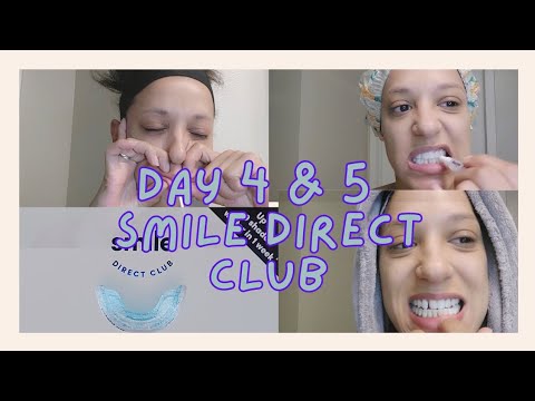 Day 4 & 5 Smile Direct Club Teeth Whitening #smiledirectclub # ...