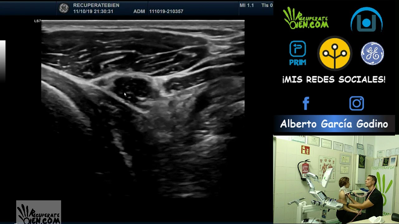 apófisis coracoides - YouTube
