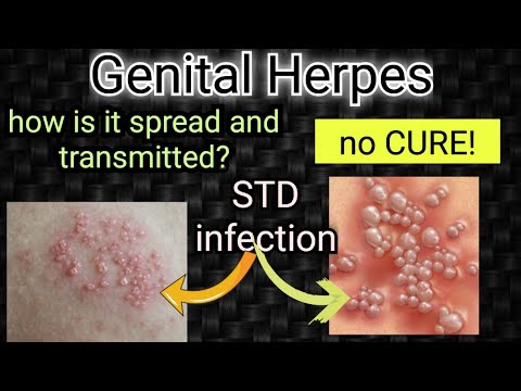 Genital Herpes and Oral Herpes a Sexually Transmitted Disease ...