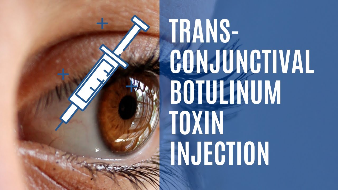 Botulinum Toxin Injection in Lateral rectus palsy - Transconjunctival ...