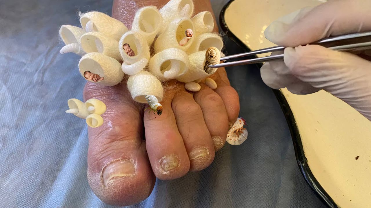 parasites-almost-ate-this-foot-saved-a-limb-from-trypophobia-youtube