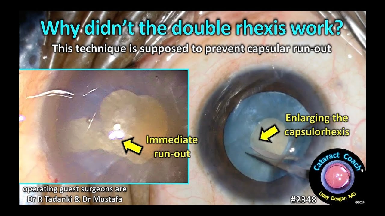 CataractCoach™ 2348: Why didn't the double rhexis work? - YouTube