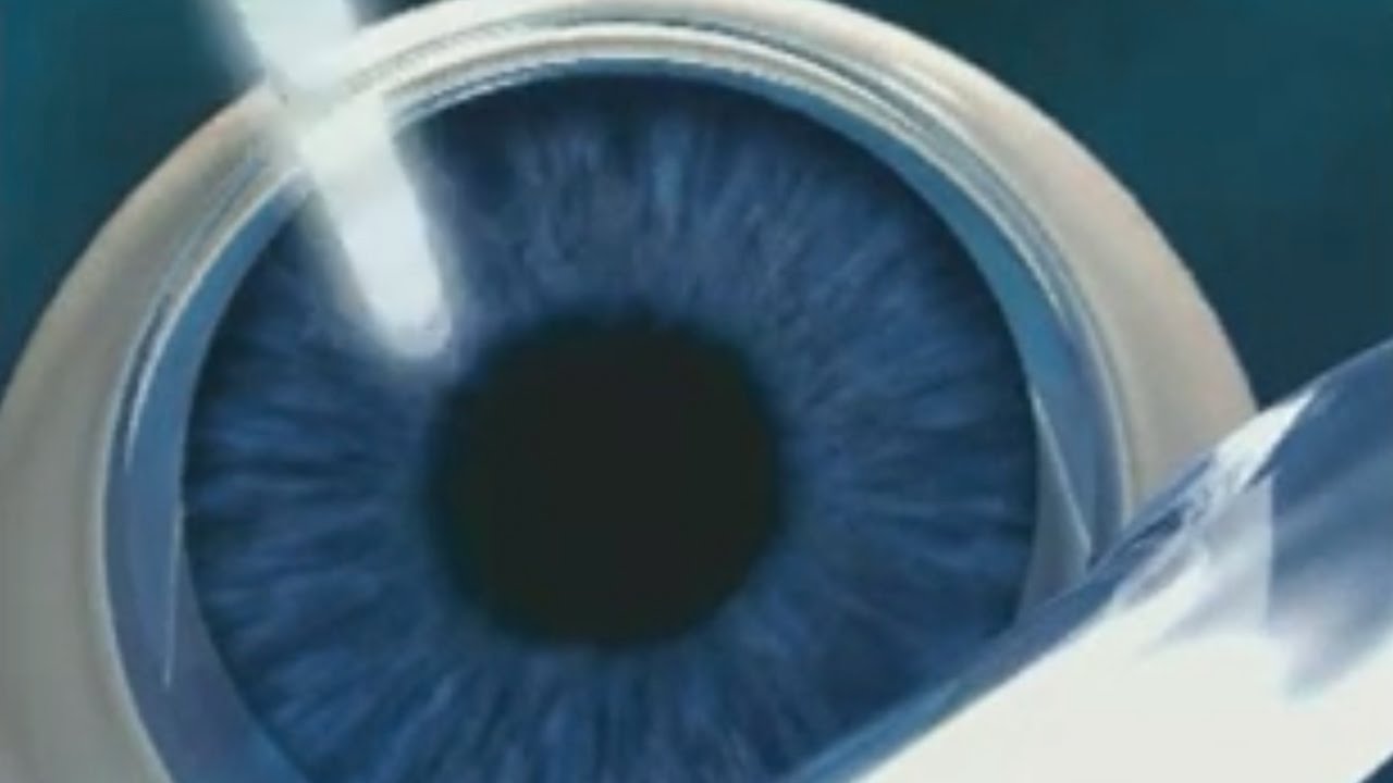 Stanford Hospitals and Clinics: laser vision correction: IntraLASIK ...