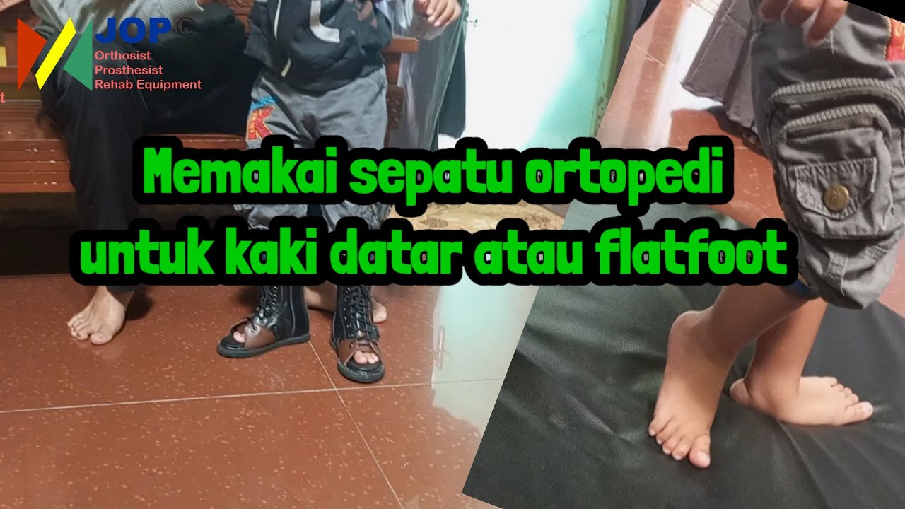 MEMAKAI SEPATU ORTOPEDI UNTUK KAKI DATAR ATAU FLAT FOOT | JOP Official ...
