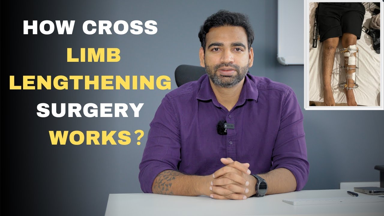 HOW CROSS LIMB LENGTHENING SURGERY WORKS ? #limblengtheningsurgery # ...