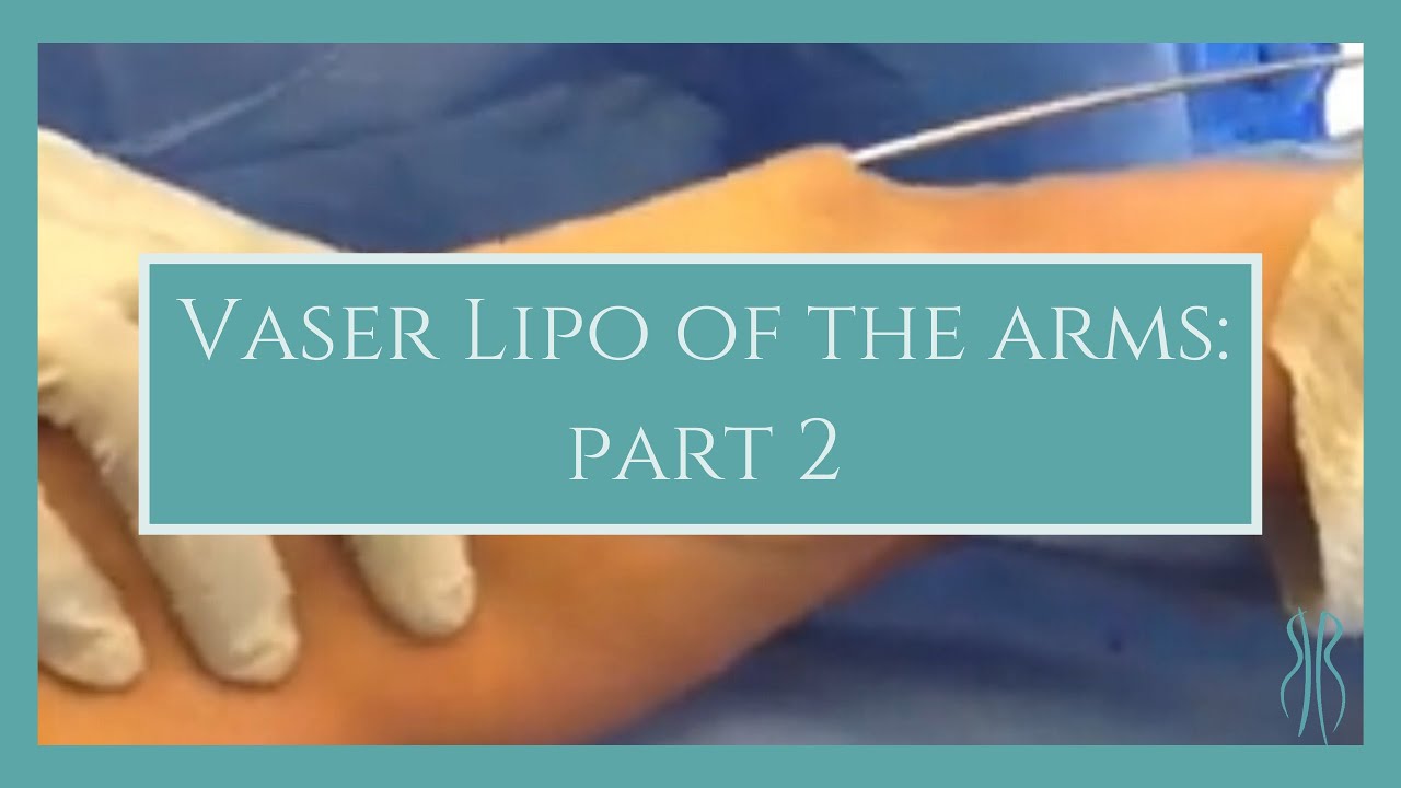 Vaser Lipo of the Arms (part 2) - YouTube