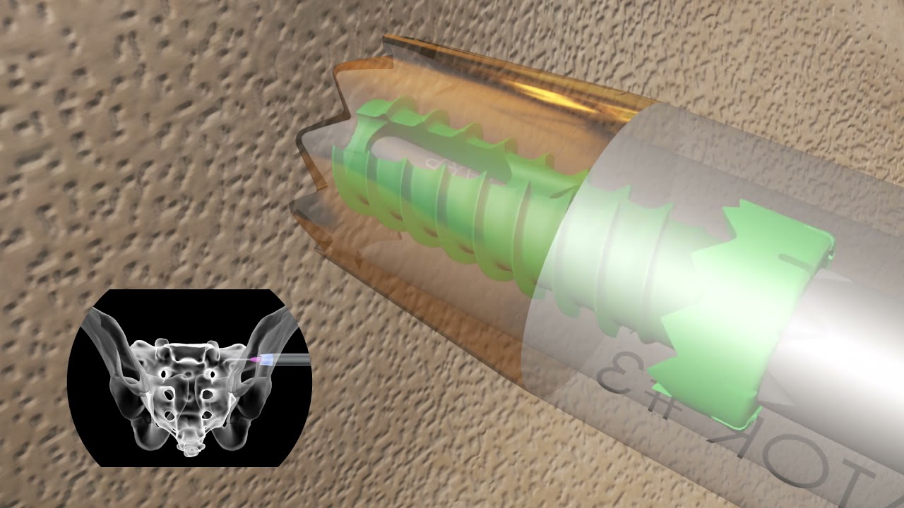 SI-Restore: SI-Restore® Sacroiliac Joint Fixation System - YouTube