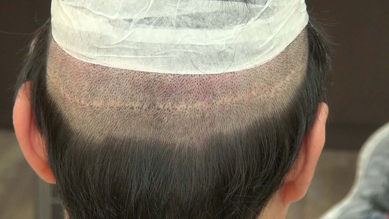 FUT Scar Hair Transplant Donor Scar Demonstration of Linear Scar by Dr ...