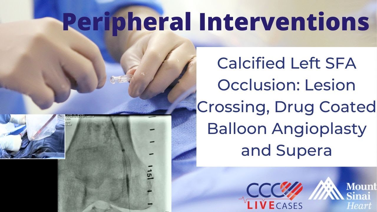 Calcified L SFA Occlusion: Lesion Crossing, Drug Coated Balloon ...