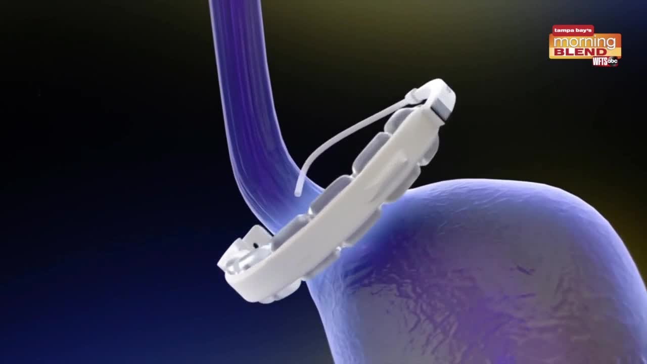 Benefits of Lap Band Surgery | Morning Blend - YouTube