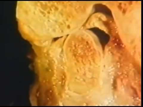 TMJ disk perforation - YouTube