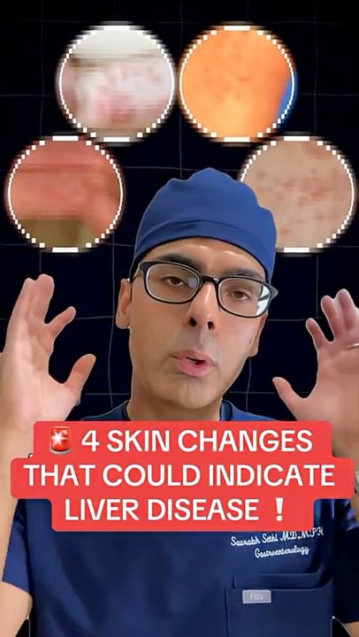 4 skin changes that could indicate liver disease ️ - YouTube