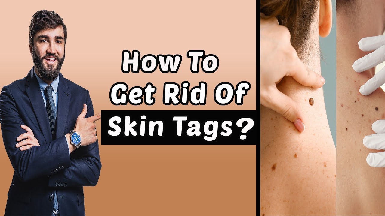 How to get rid of skin tags? - YouTube