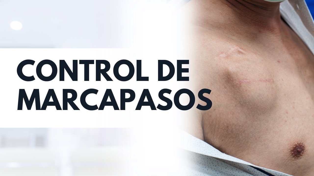 ¿Como se controla un marcapasos? ¡Todos los secretos revelados! - YouTube