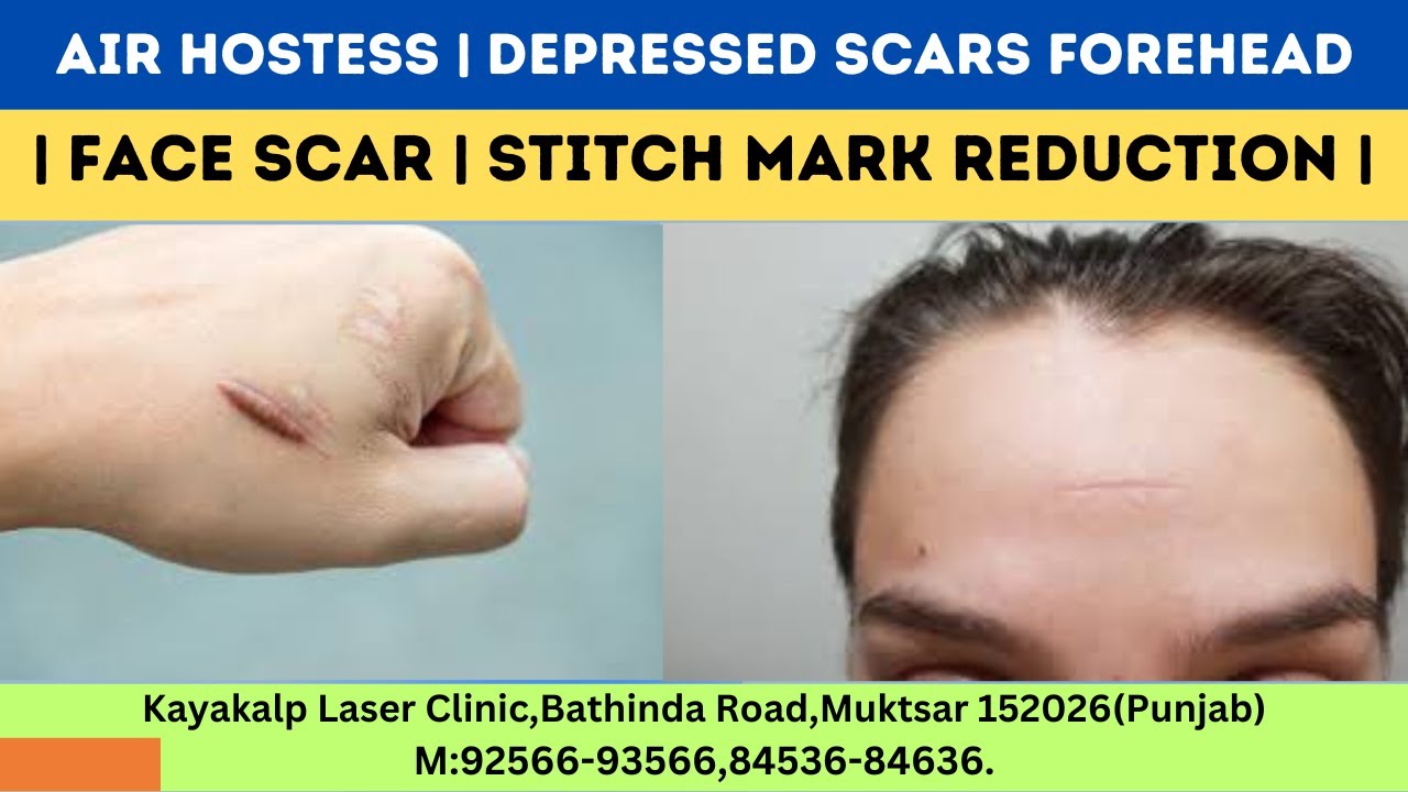 Air Hostess | Depressed Scars Forehead | Face Scar | Stitch Mark ...