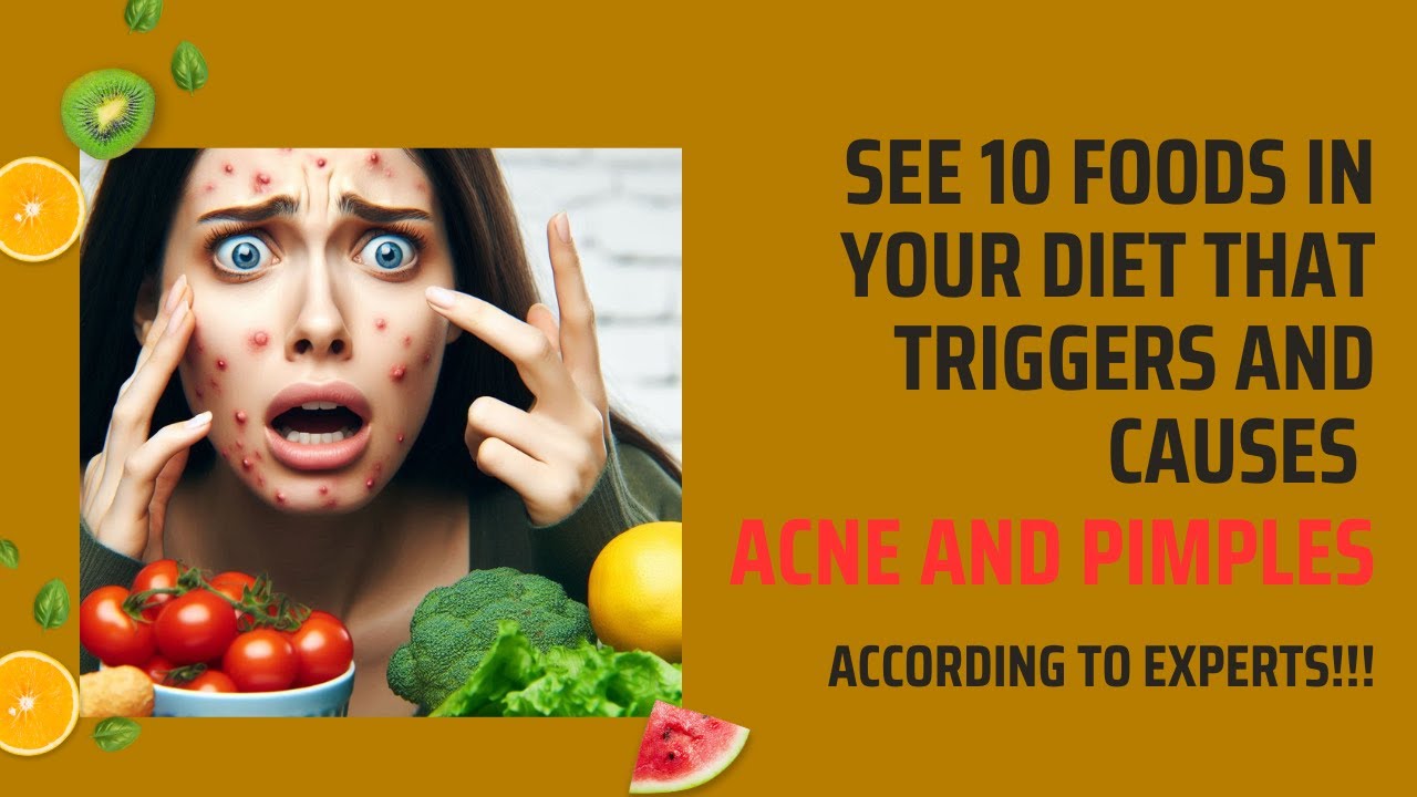 10 Foods That Trigger Acne AND Pimples . SHOCKING!!! - YouTube