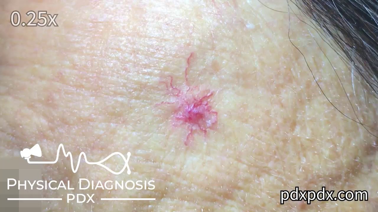 Spider Angioma - YouTube
