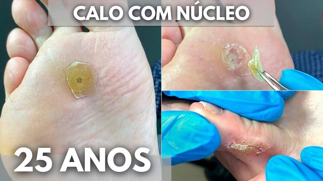 Remoção de Calo com Núcleo / Calo Interdigital - YouTube